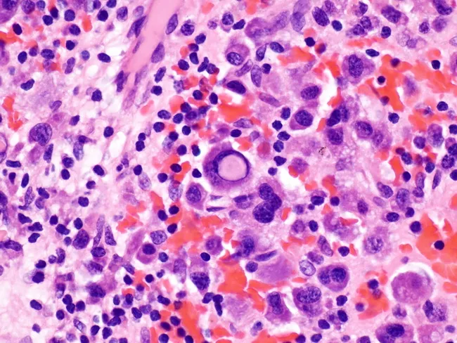 Myeloma : Dutcher Bodies