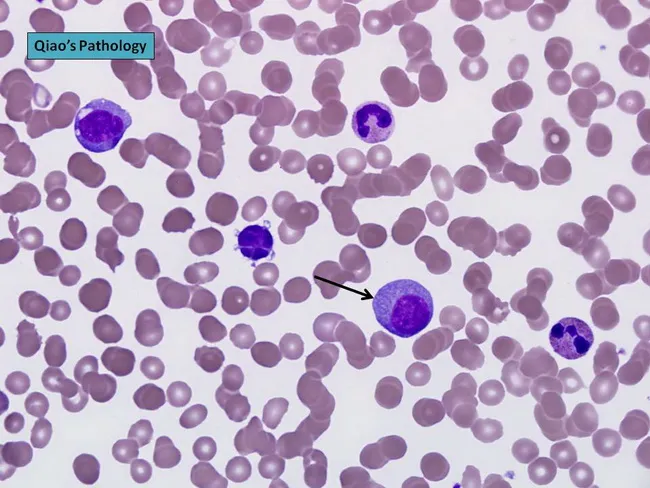 Blood Plasma Cell Blood Academy On X: "1/ Plasma Cells With Unusual