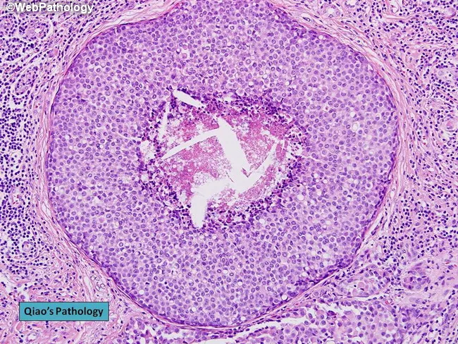 Lobular Carcinoma-In-Situ