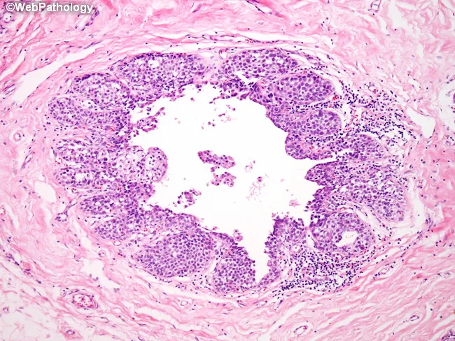Lobular Carcinoma-In-Situ