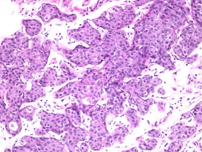 LCIS in Sclerosing Adenosis