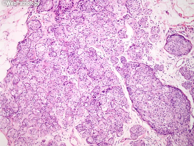 LCIS in Sclerosing Adenosis