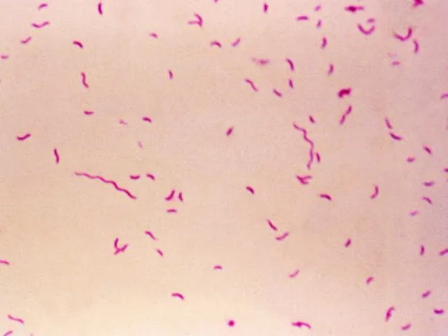 Campylobacter & Alpha Heavy Chain Disease