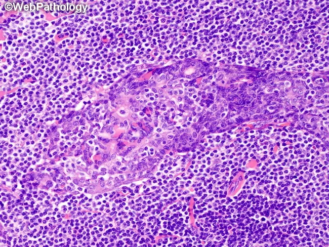 MALT Lymphoma : Lymphoepithelial Lesions