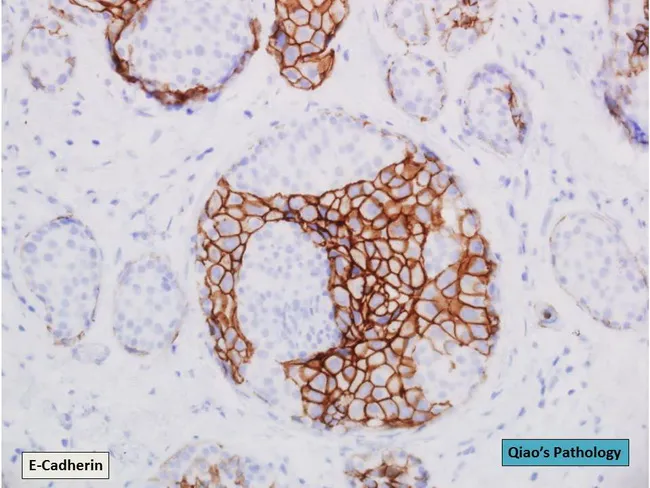 E-Cadherin in LCIS & DCIS
