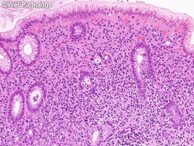 Gastric MALT Lymphoma - Morphology