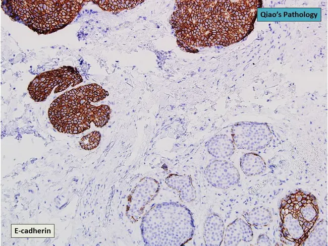 E-Cadherin in LCIS & DCIS