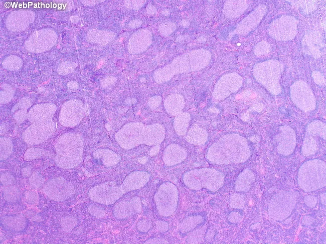 Follicular Lymphoma: Growth Pattern