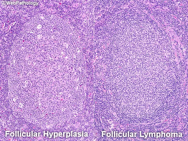 Follicular Lymphoma vs Follicular Hyperplasia