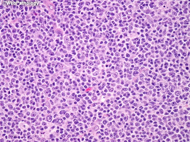 Follicular Lymphoma : Grade 3a