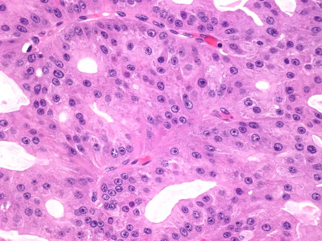 Papillary Carcinoma of Breast : Apocrine change