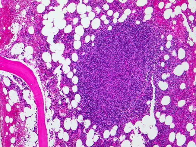 Follicular Lymphoma : Bone Marrow