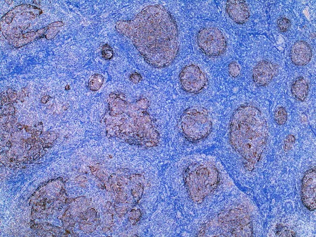 Follicular Lymphoma : CD21