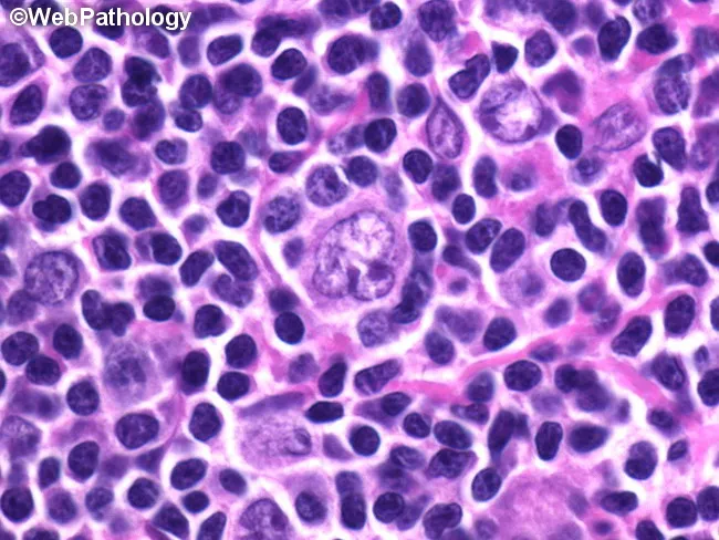 NLPHL : LP (Popcorn) Cells
