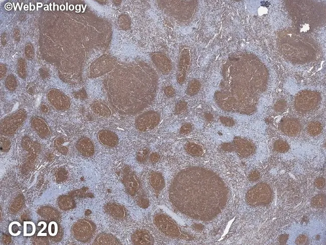 Progressive Transformation of Germinal Centers (PTGC)