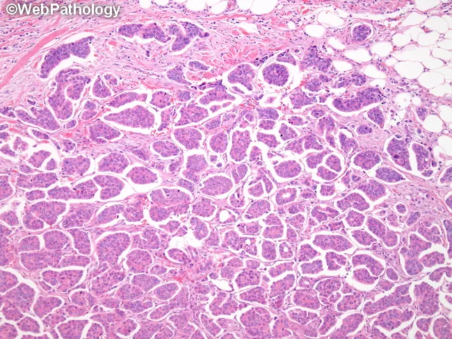 Micropapillary Carcinoma of Breast