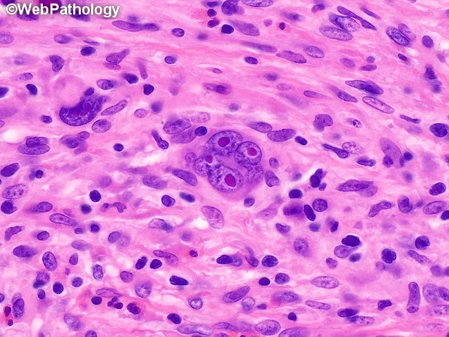 Reed-Sternberg Cells