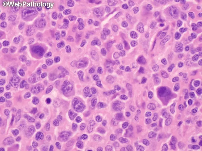 Mummified Reed-Sternberg Cells