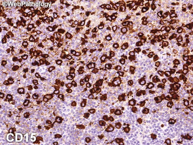 Reed-Sternberg Cells : CD15