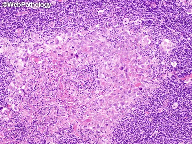 Nodular Sclerosis Hodgkin Lymphoma, Syncytial Variant