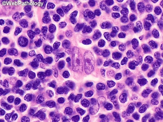 Lymphocyte-rich Hodgkin Lymphoma