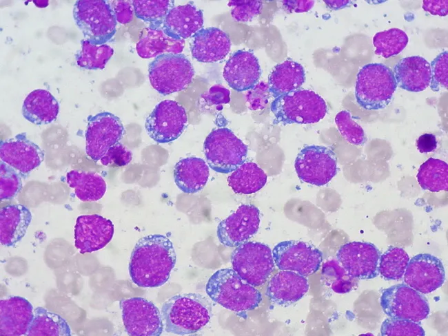 Burkitt Lymphoma