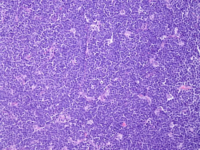 Burkitt Lymphoma