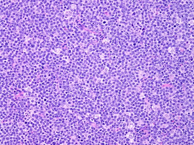 Burkitt Lymphoma