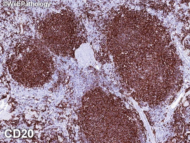 Cutaneous Follicle Center Lymphoma : CD20