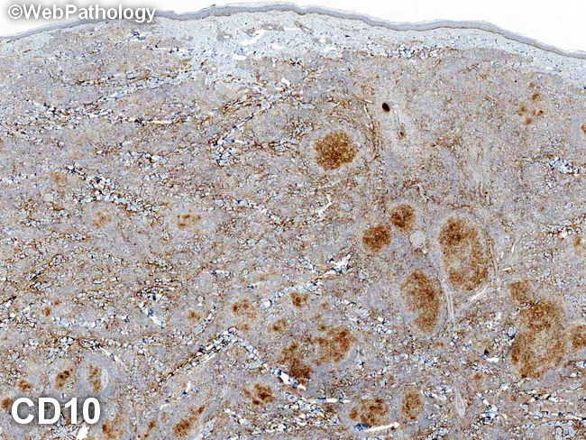 Cutaneous Follicle Center Lymphoma : CD10
