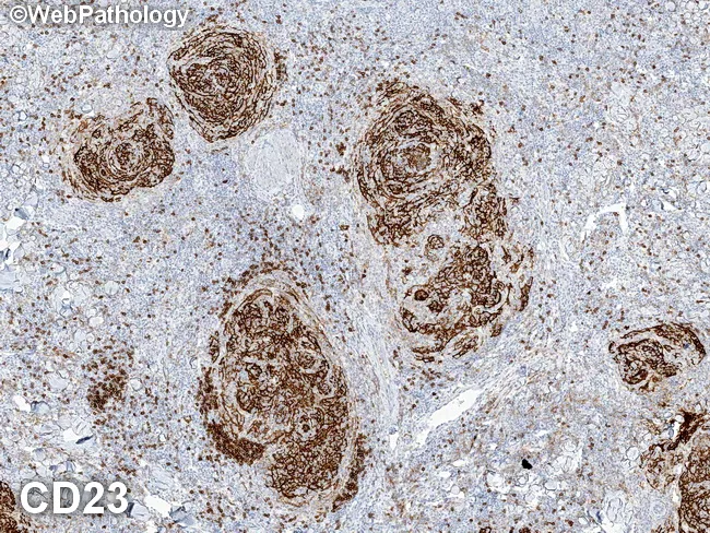 Cutaneous Follicle Center Lymphoma : CD23