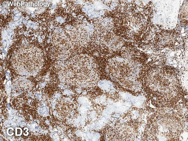 Cutaneous Follicle Center Lymphoma : CD3
