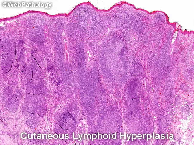 Cutaneous Follicle Center Lymphoma : Differential
