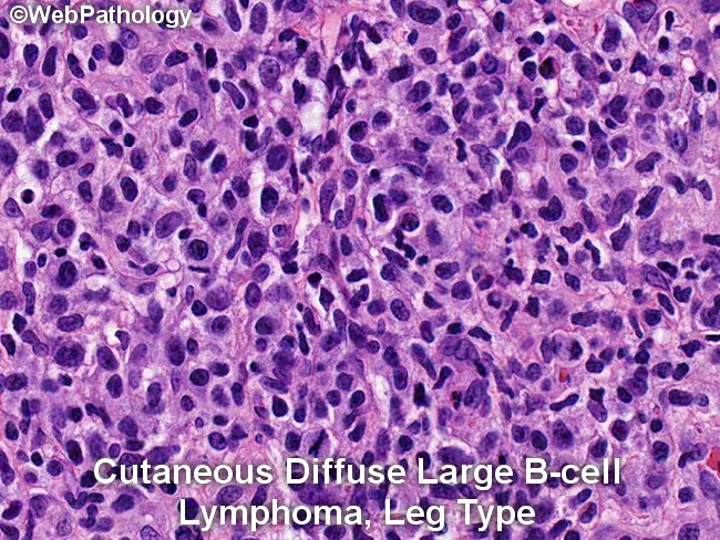 Cutaneous Follicle Center Lymphoma : Differential
