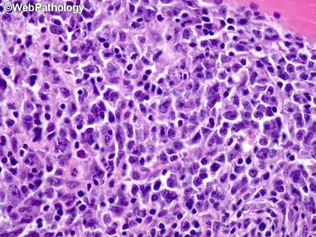 Primary Cutaneous Diffuse Large B-cell Lymphoma, Leg Type