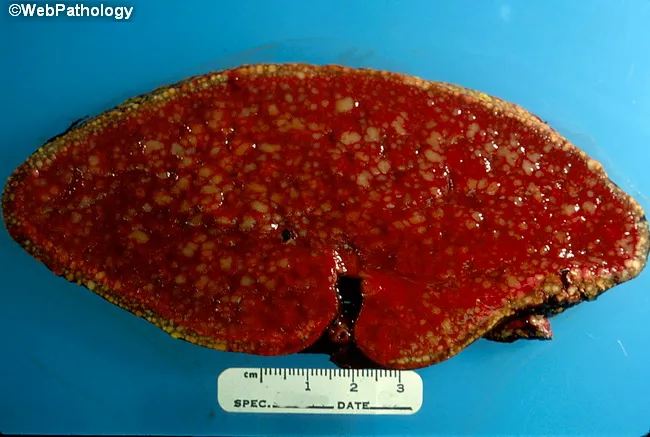 Mantle Cell Lymphoma : Spleen