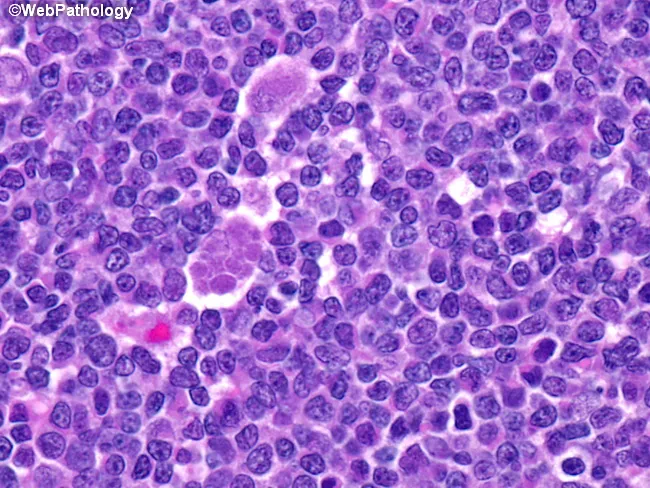 Mantle Cell Lymphoma : Spleen