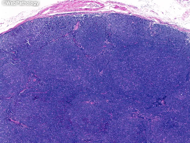 Mantle Cell Lymphoma : Lymph Node