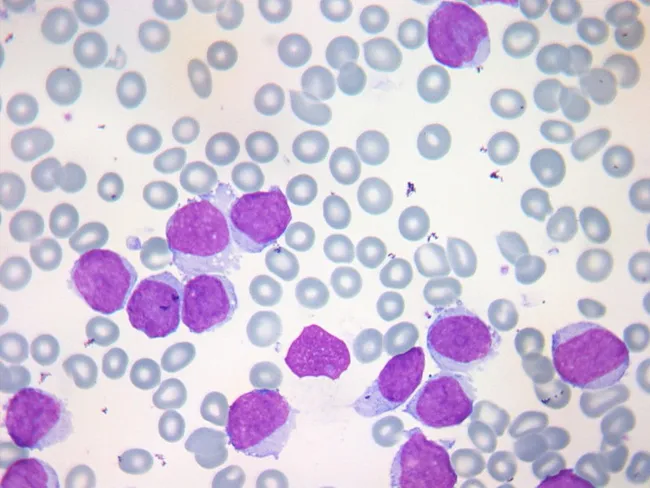 Mantle Cell Lymphoma : Peripheral Blood