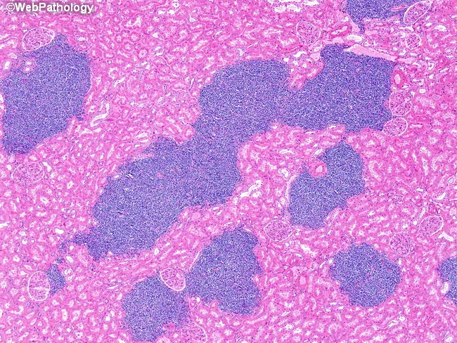 Mantle Cell Lymphoma : Kidney