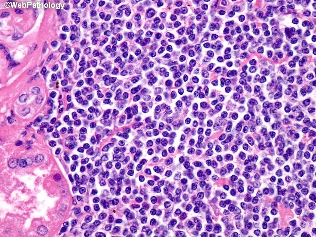 Mantle Cell Lymphoma : Kidney