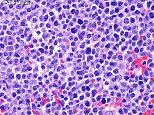 Mantle Cell Lymphoma : Blastoid