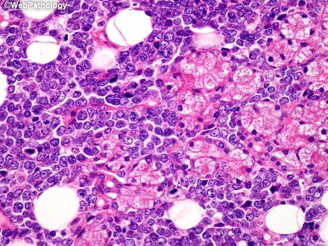 Mantle Cell Lymphoma : Blastoid
