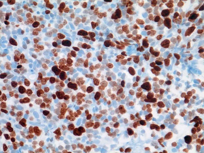 Mantle Cell Lymphoma : Ki-67