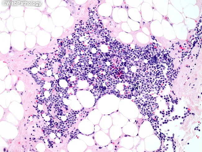 DLBCL : Lymph Node