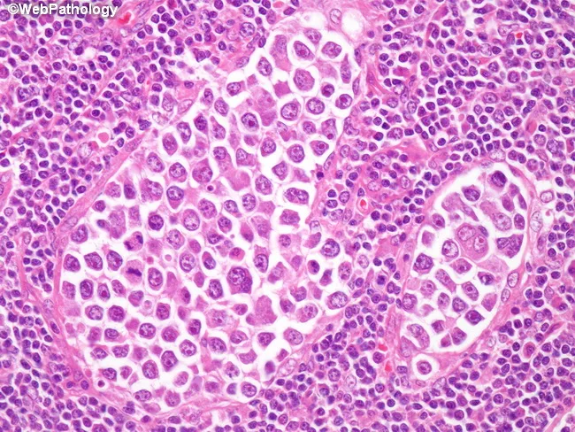 DLBCL : Sinusoidal Pattern