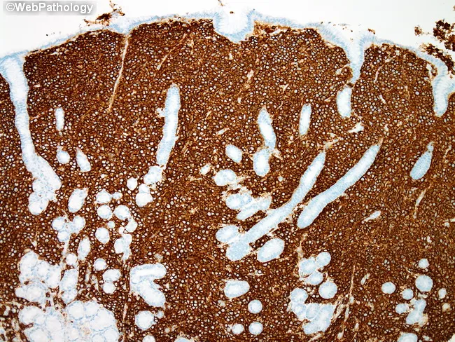 DLBCL : Stomach - CD20