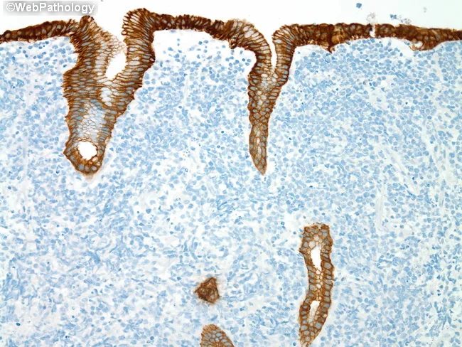 DLBCL : Stomach - PanKeratin