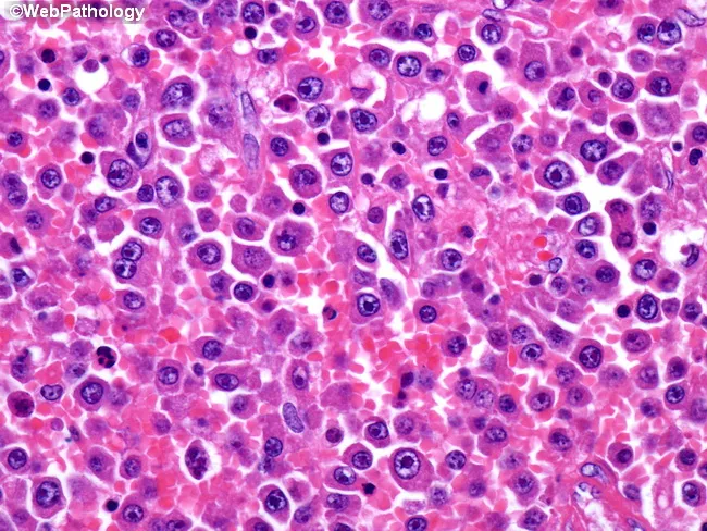 DLBCL : Colon