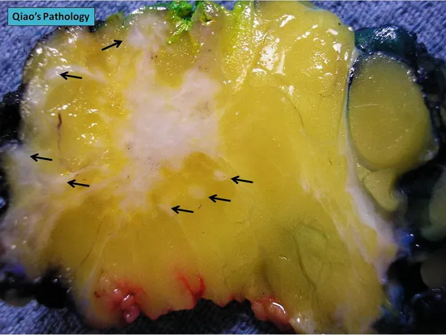Invasive Ductal CA : Multifocal Tumors